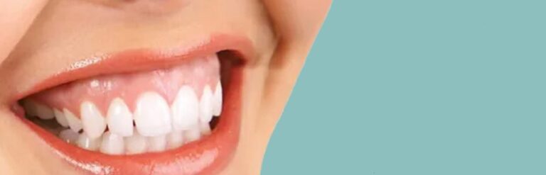 What Is A Gummy Smile? - Full Mouth Dental Implants